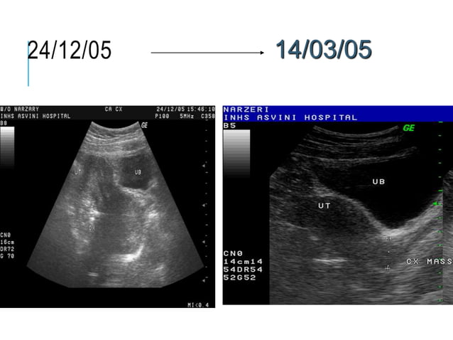 Ca Cervix.ppt | Cancer | Diseases and Conditions
