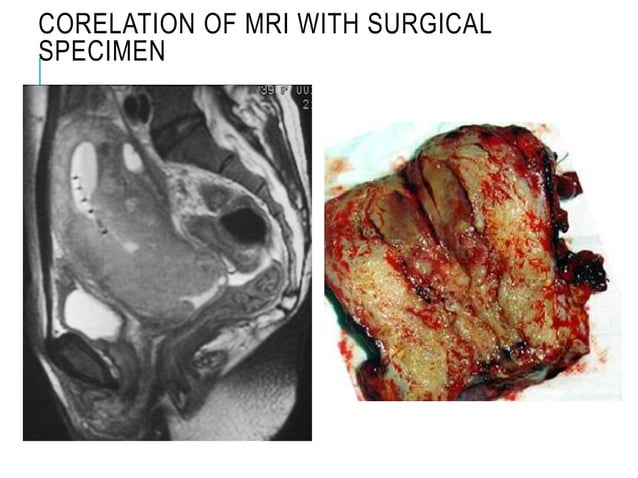 Ca Cervix.ppt | Cancer | Diseases and Conditions