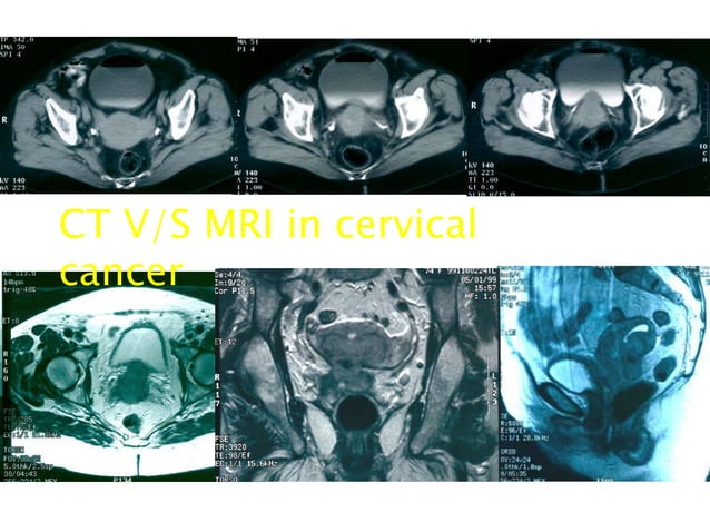 Ca Cervix.ppt | Cancer | Diseases and Conditions