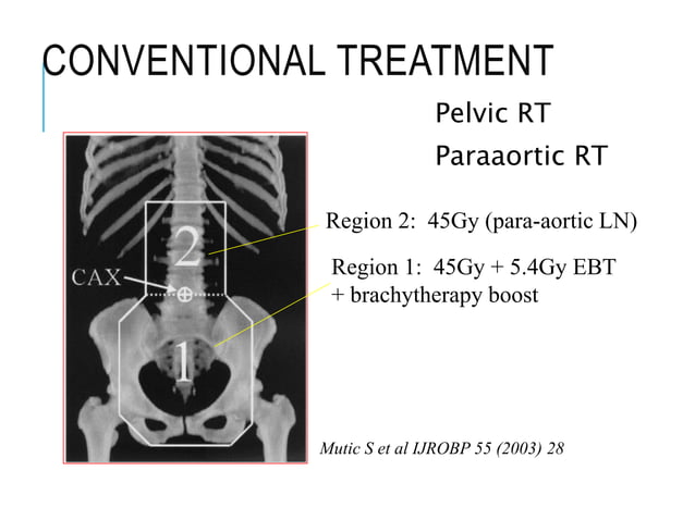 Ca Cervix.ppt | Cancer | Diseases and Conditions