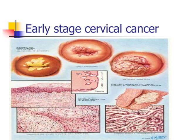 CA Cervix +.ppt