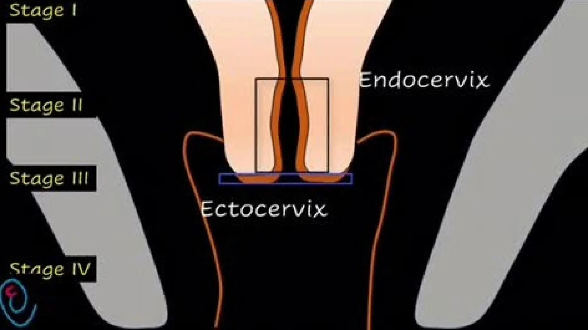 Carcinoma CERVIX - FIGO staging .......Carcinoma cervix Anatomy ...