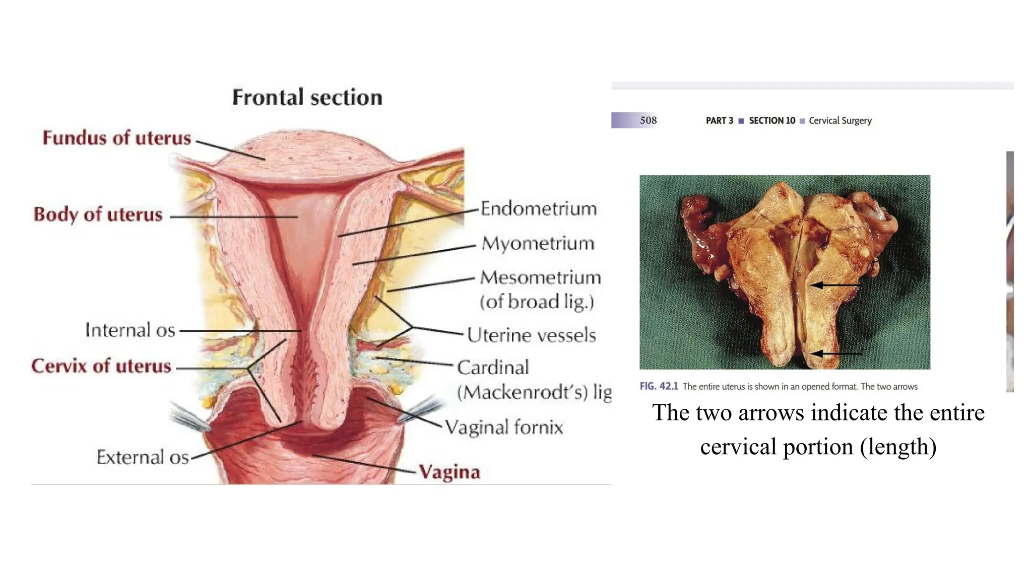 Carcinoma CERVIX - FIGO staging .......Carcinoma cervix Anatomy Lymphatic drainage ...