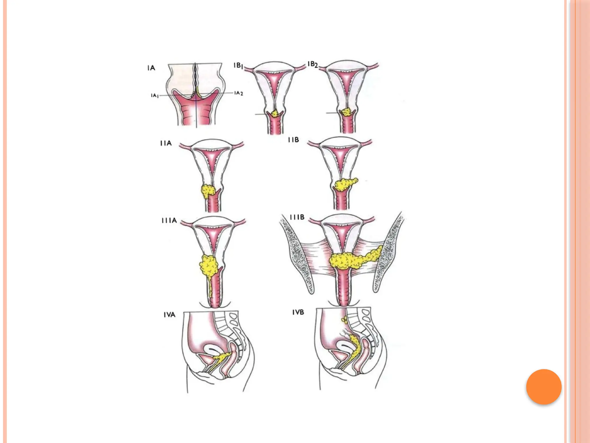 CA CERVIX Anatomy, pathogenesis, clinical features, management, | PPT