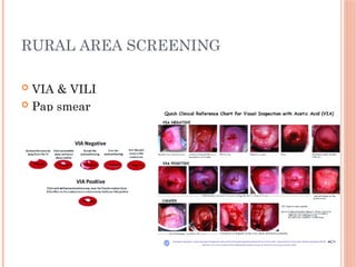 CA CERVIX Anatomy, pathogenesis, clinical features, management, | PPT