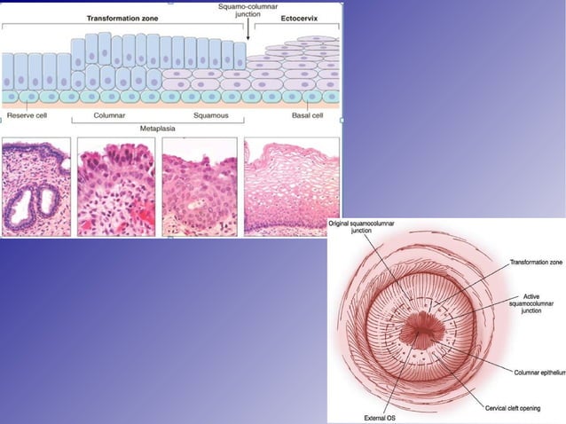 Ca cervix evaluation and staging | PPT