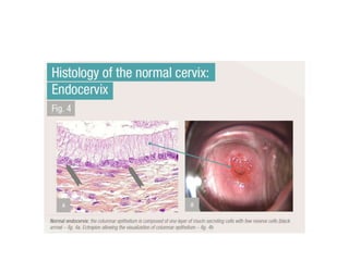 Ca cervix pre managment | PPTX