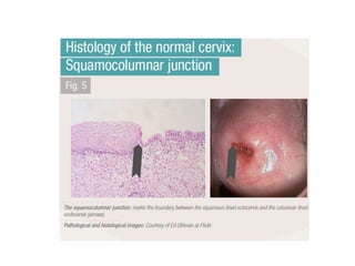 Ca cervix pre managment | PPTX