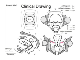 Ca cervix pre managment | PPTX