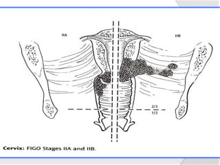 Ca cervix—standards of care | PPTX