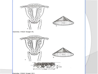 Ca cervix—standards of care | PPTX