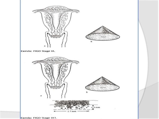 Ca cervix—standards of care