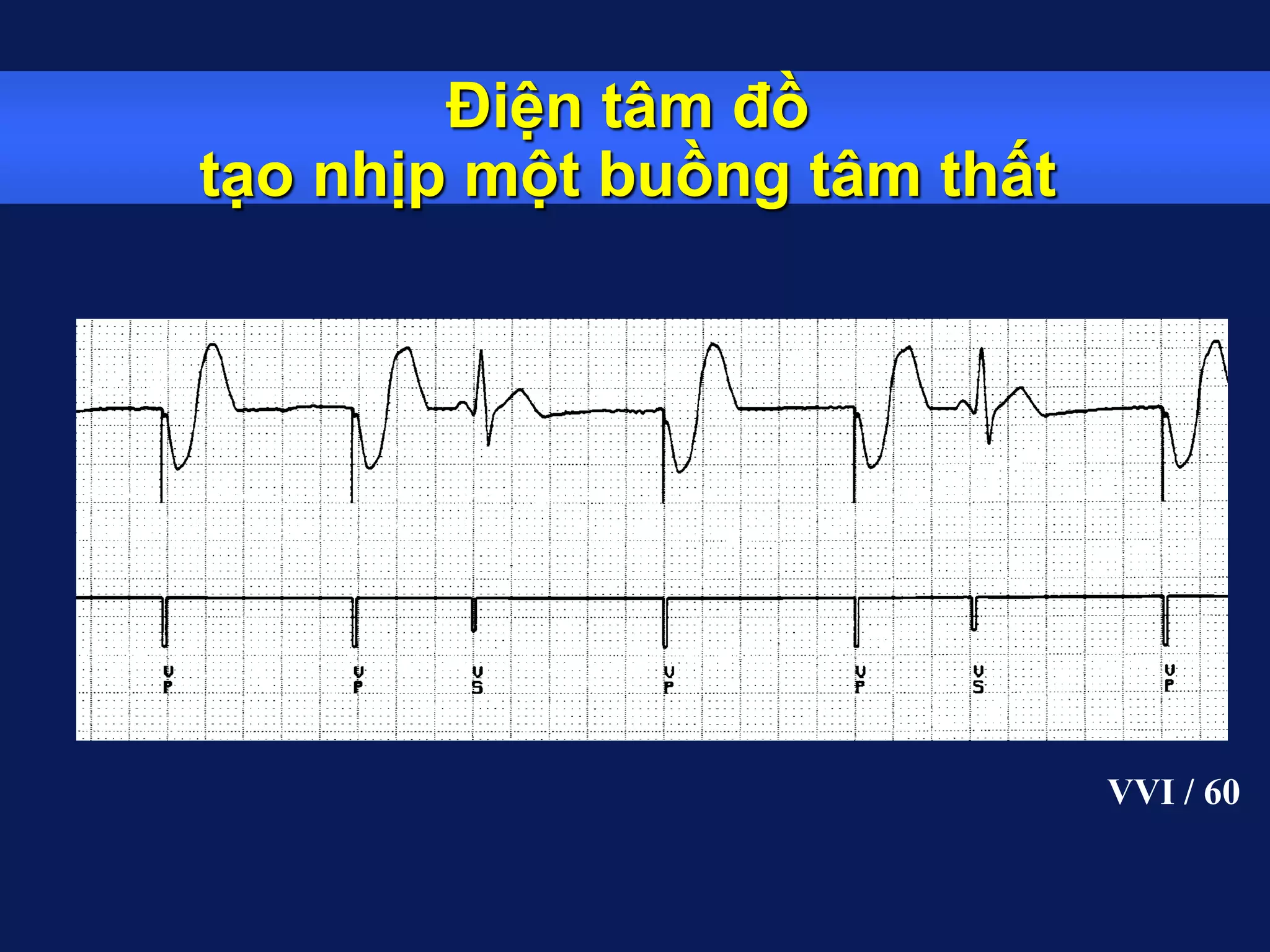 Cac khai niem co ban ve may tao nhip va cach nhan biet dien tam do may ...