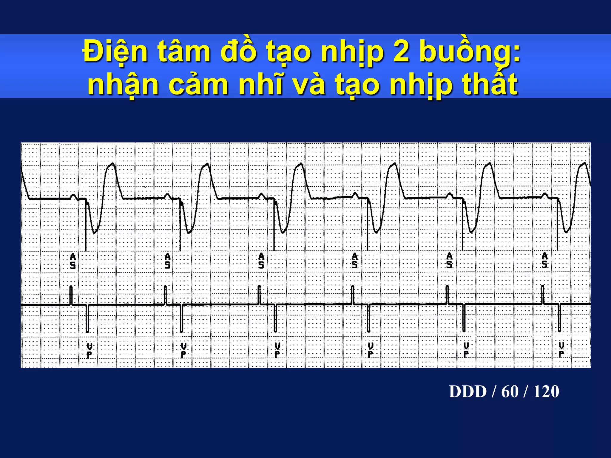 Cac khai niem co ban ve may tao nhip va cach nhan biet dien tam do may ...