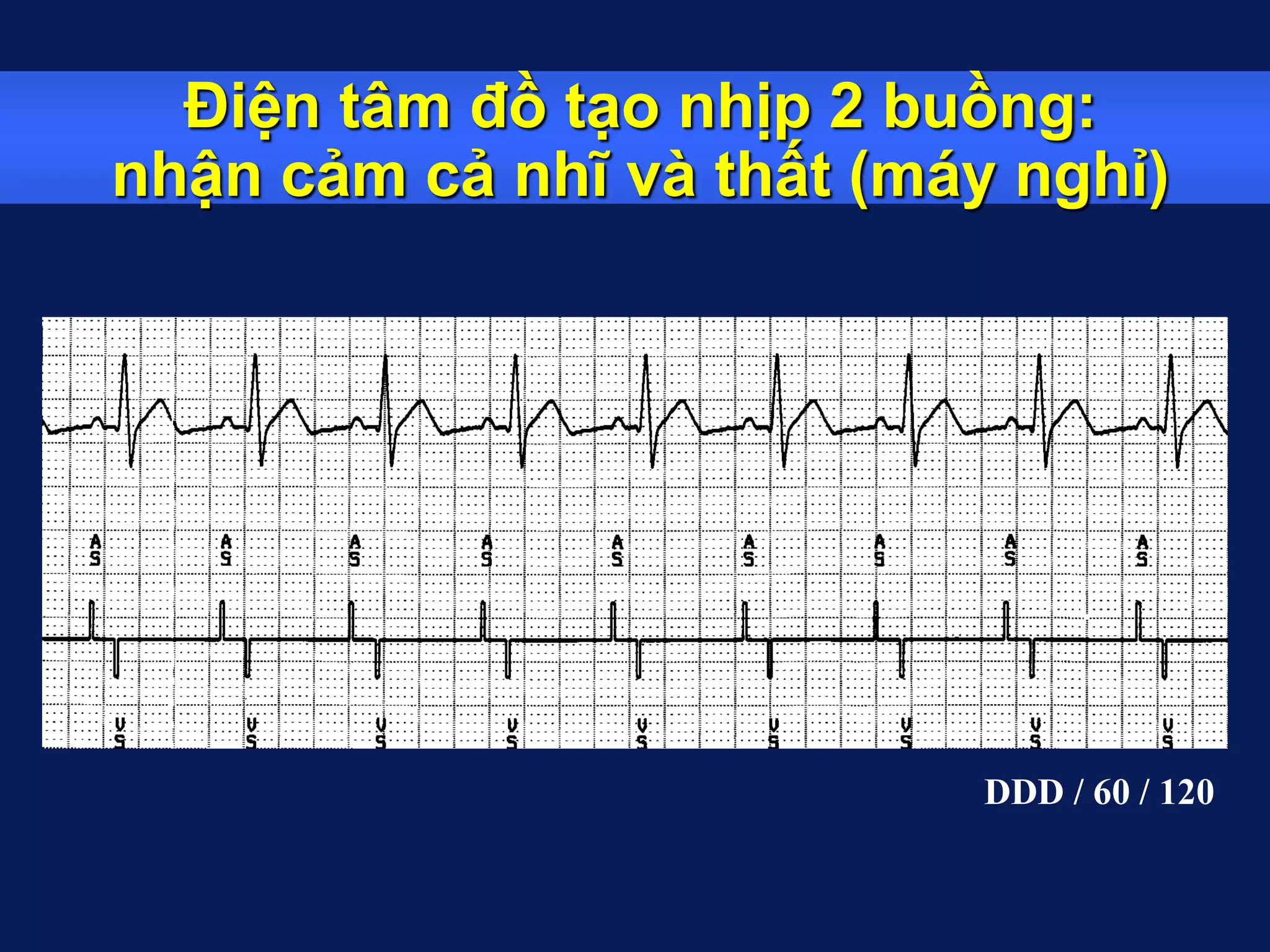 Cac khai niem co ban ve may tao nhip va cach nhan biet dien tam do may ...