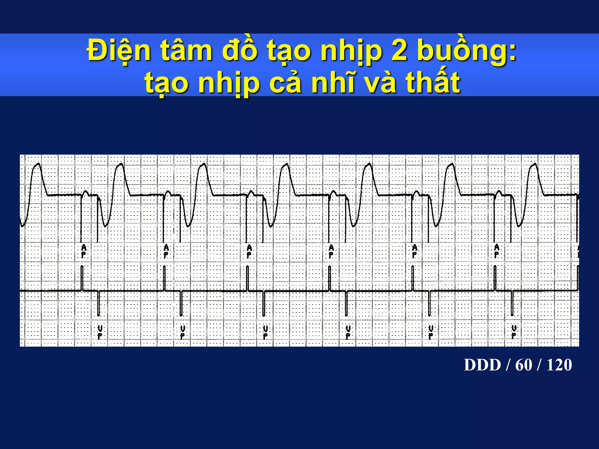 Cac khai niem co ban ve may tao nhip va cach nhan biet dien tam do may ...