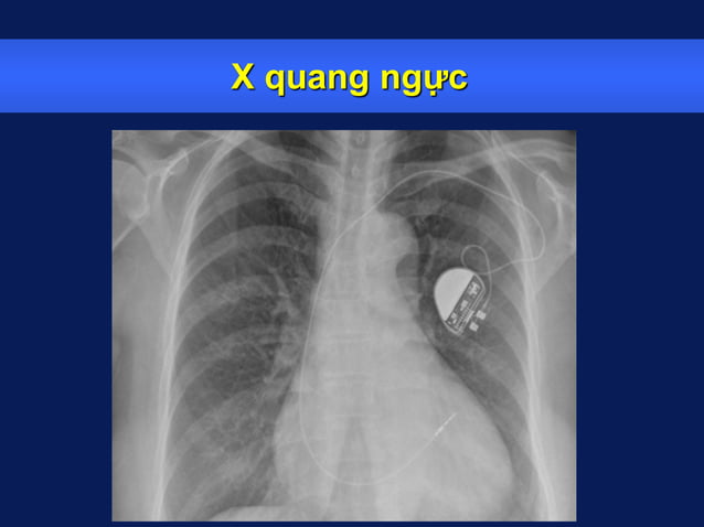 Cac khai niem co ban ve may tao nhip va cach nhan biet dien tam do may ...