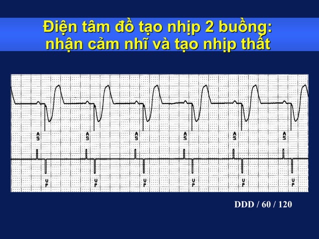 Cac khai niem co ban ve may tao nhip va cach nhan biet dien tam do may ...