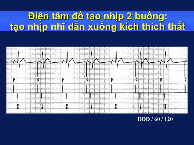 Cac khai niem co ban ve may tao nhip va cach nhan biet dien tam do may ...