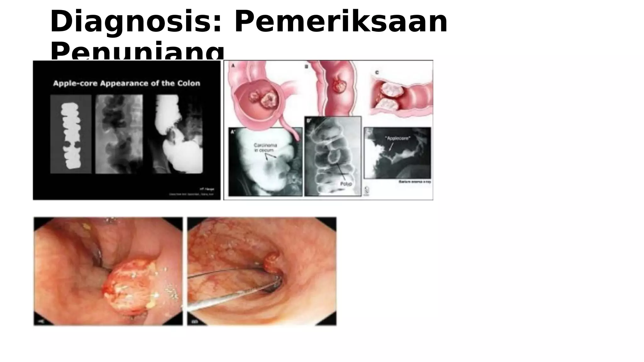 Ca colon muhammad sobri maulana | PPT