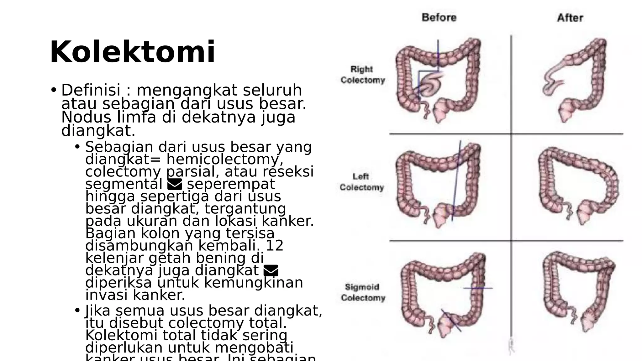 Ca colon muhammad sobri maulana | PPT