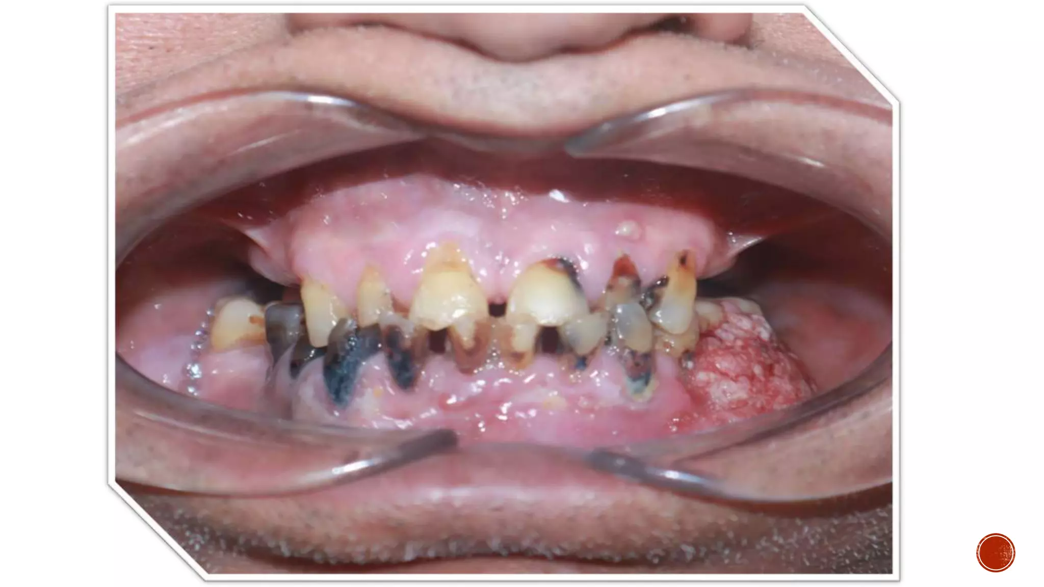 oral cancer case presentation.pptx
