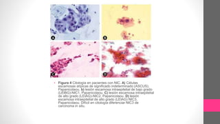 Cancer Cervico uterino (neoplasia comun) | PPTX