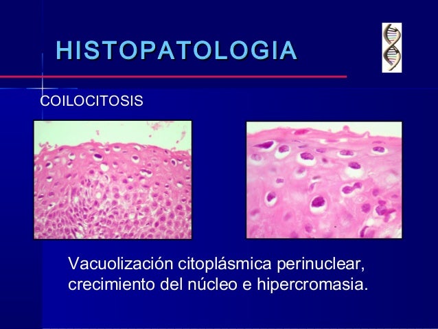 CANCER CERVICOUTERINO Y VPH