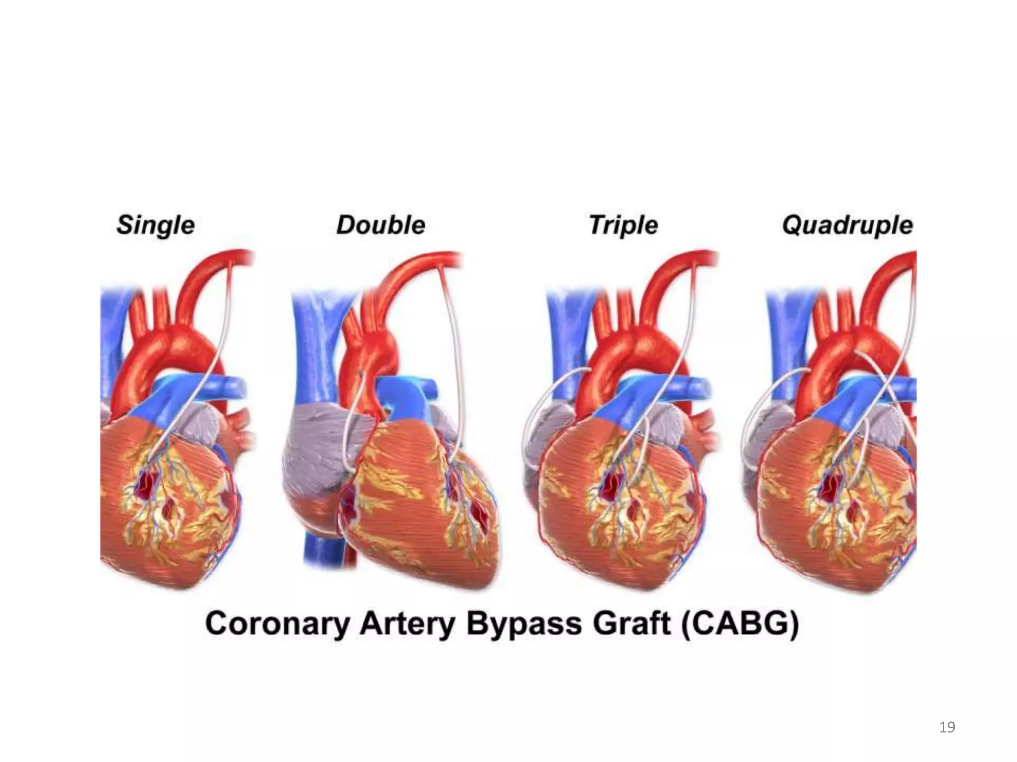 coronary artery disease (CAD) | PPTX