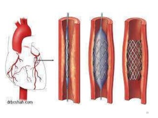 coronary artery disease (CAD) | PPTX