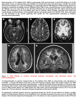 Topic of the month.... Hereditary subcortical vascular dementia ...