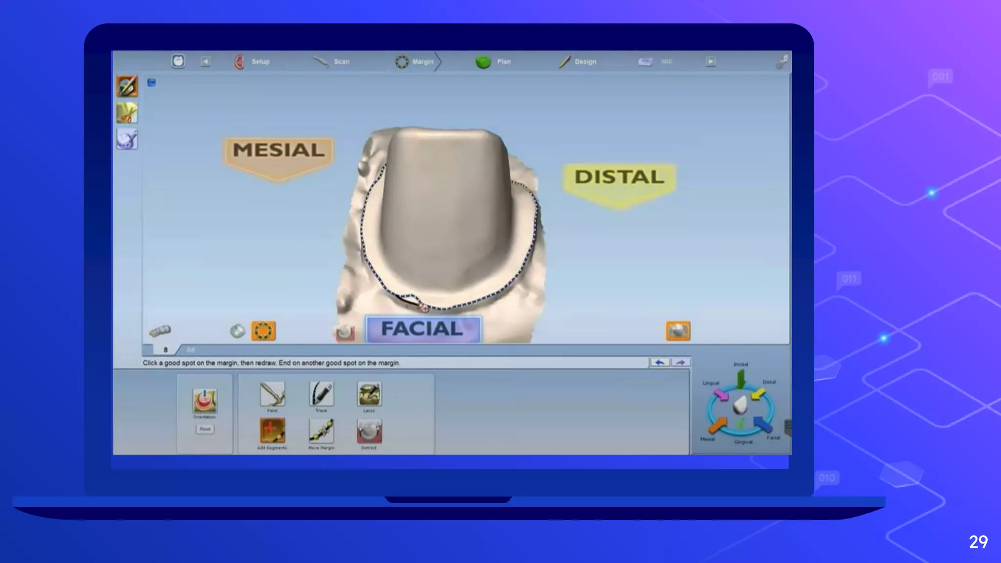 Cadcam in Dentistry | PPTX