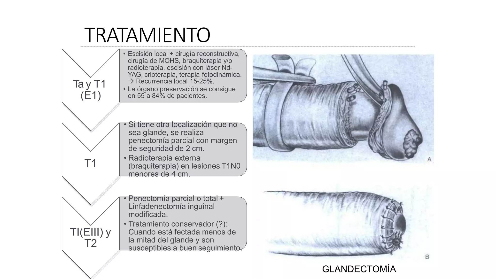 Cáncer de pene | PPTX