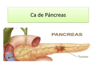 Ca de Páncreas.pptx