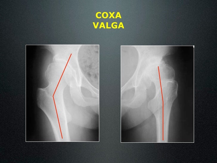 Cadera