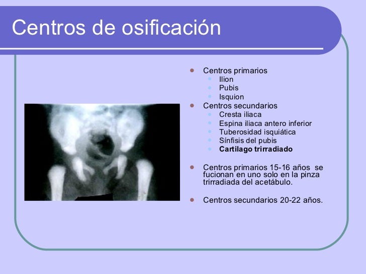 Cadera Infantil