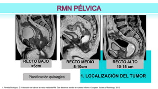 Cancer de Recto | PPTX