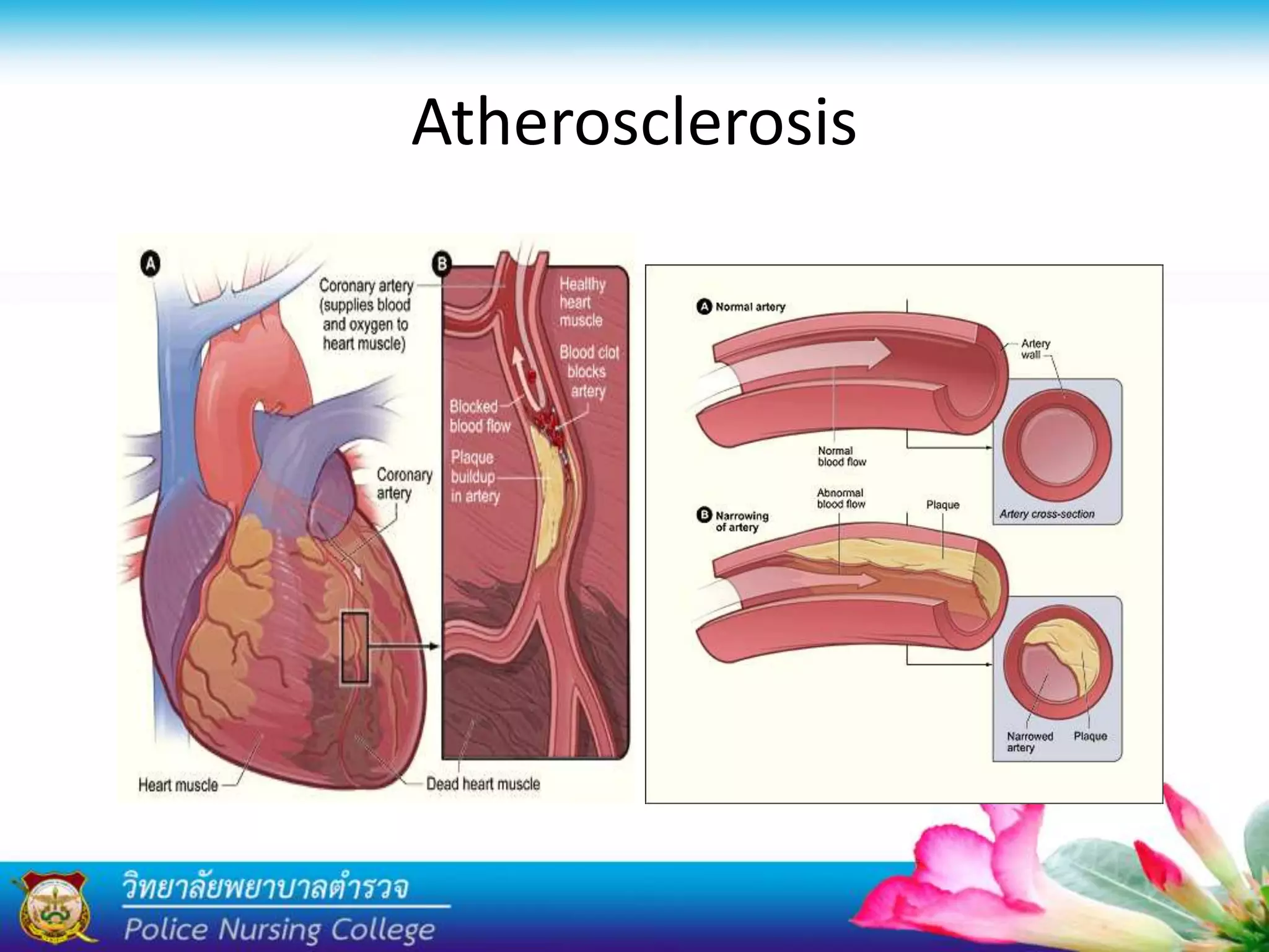 CAD IHD and VHD | PPTX
