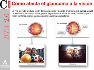 Tratamiento farmacológico del glaucoma de ángulo abierto: actualización ...