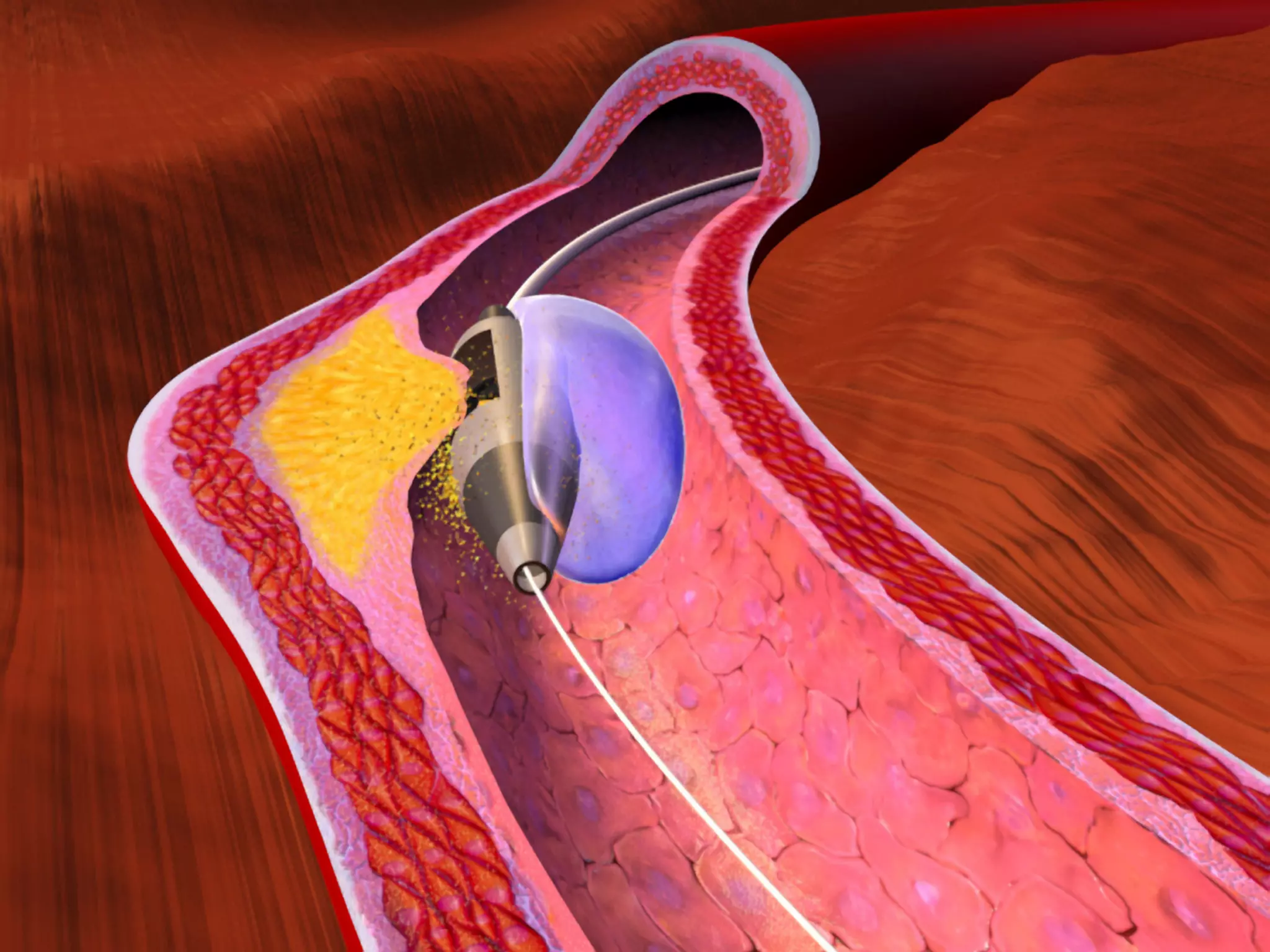 CAD AND MI (CORONARY ARTERY DISEASE AND MYOCARDIAL INFARCTION) | PDF