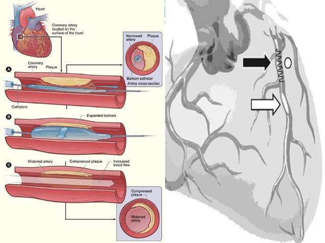 CAD AND MI (CORONARY ARTERY DISEASE AND MYOCARDIAL INFARCTION) | PDF