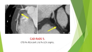 CAD RADS | PPTX | Heart and Cardiovascular Diseases | Diseases and ...