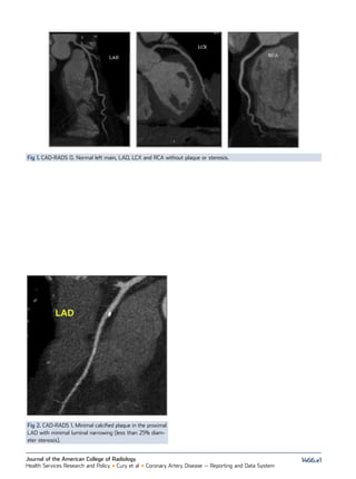 CAD RADS: Coronary Artery | PDF