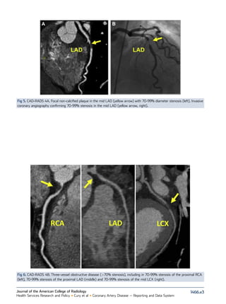 CAD RADS: Coronary Artery | PDF
