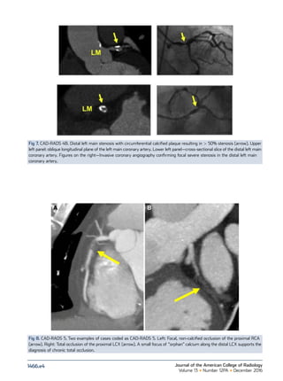 CAD RADS: Coronary Artery | PDF