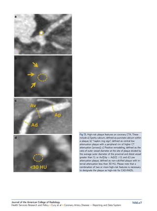 CAD RADS: Coronary Artery | PDF
