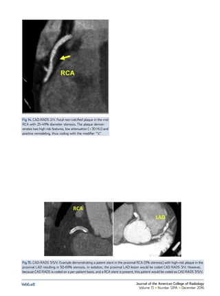CAD RADS: Coronary Artery | PDF