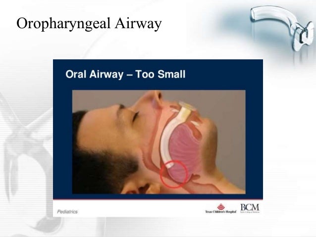 Oral Airway Presentation