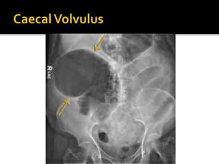 Anatomy of Caecum & Appendix.pptx