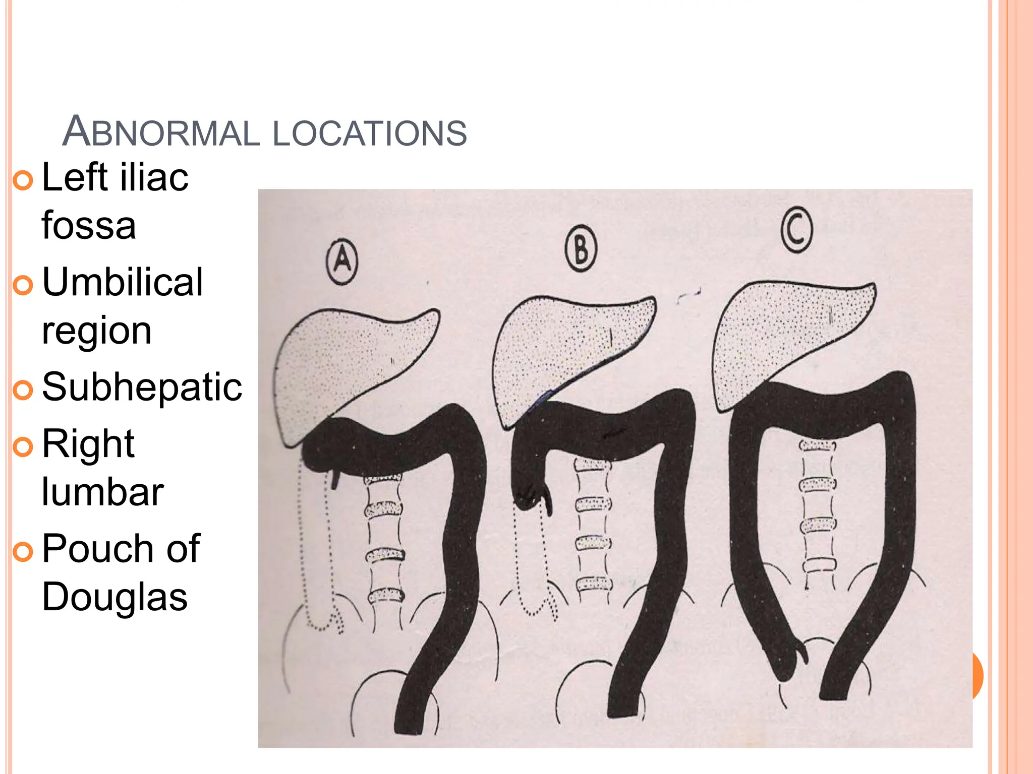 GROSS ANATOMY OF CAECUM & APPENDIX DR VKVS.ppt